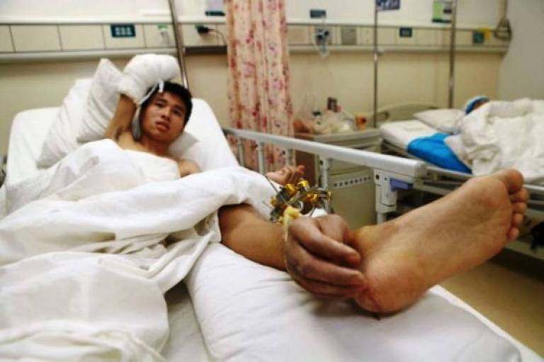 Injertar una mano en el tobillo para salvarla