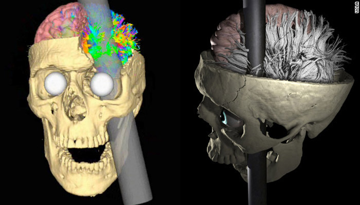 Phineas Gage: How did he survive a destroyed frontal lobe?