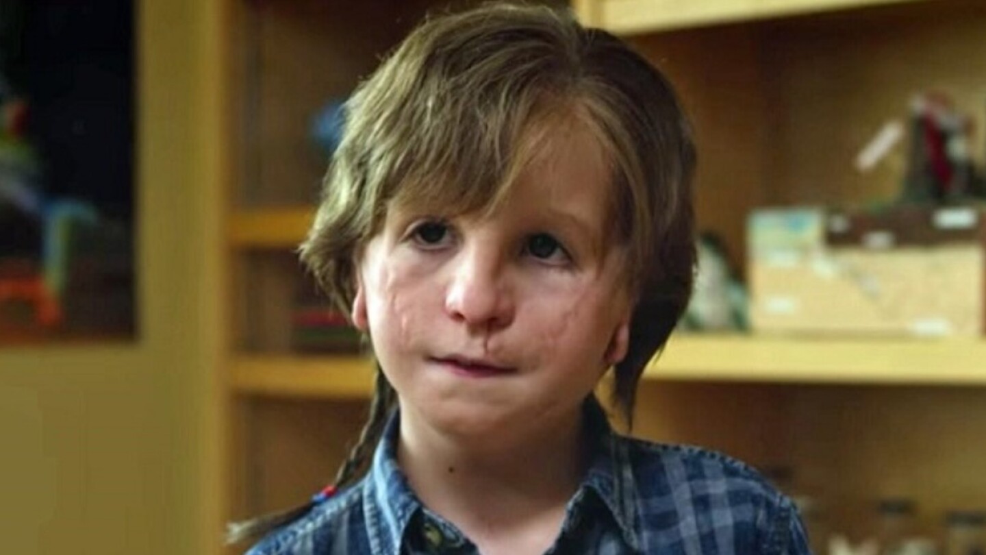 Síndrome de Treacher Collins: Toda la información