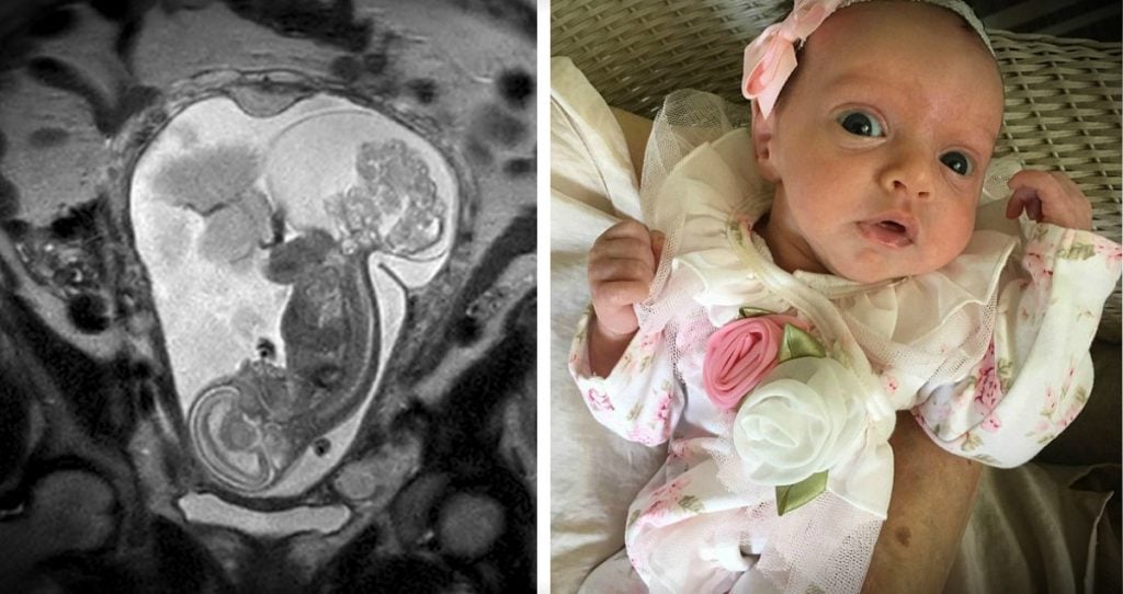 Lynlee, the Baby Who Was Born Twice